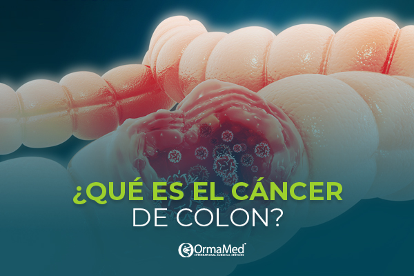 ¿Qué es el cáncer de colon y cómo lo puedes detectar?