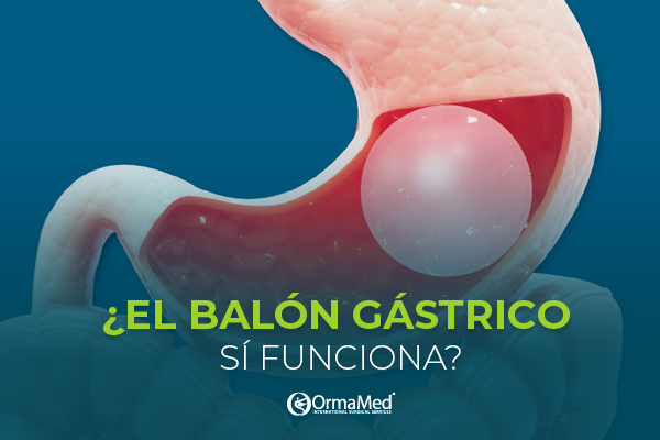 ¿El balón gástrico funciona? Nuestros casos de éxito lo comprueban.