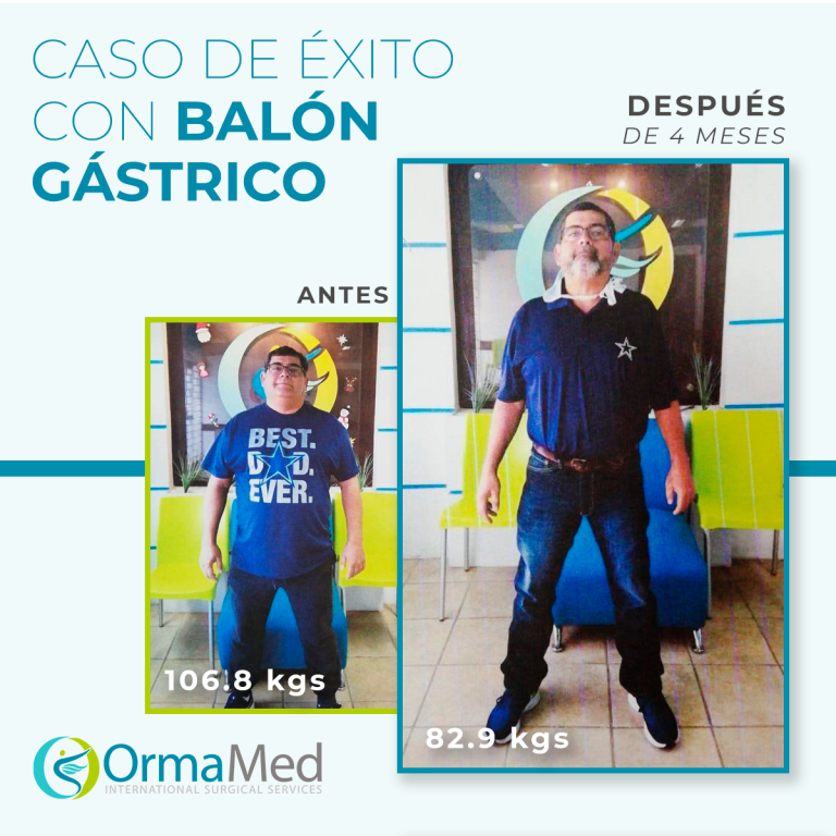 ¿El balón gástrico funciona? Nuestros casos de éxito lo comprueban.
